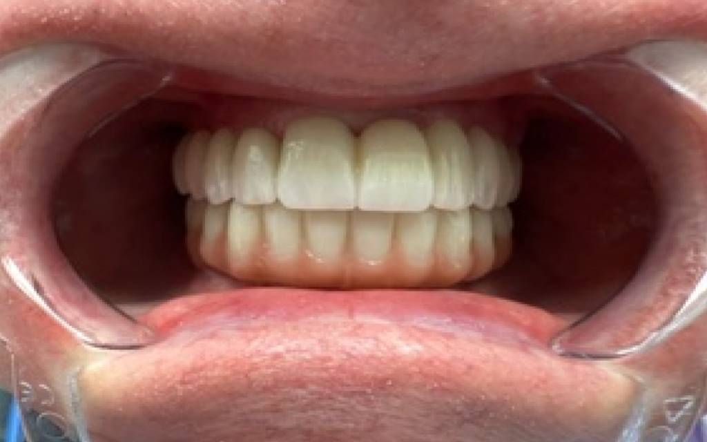 Implants - Drake Dental Lab