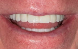 Implants - Drake Dental Lab