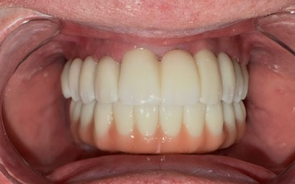 Implants - Drake Dental Lab