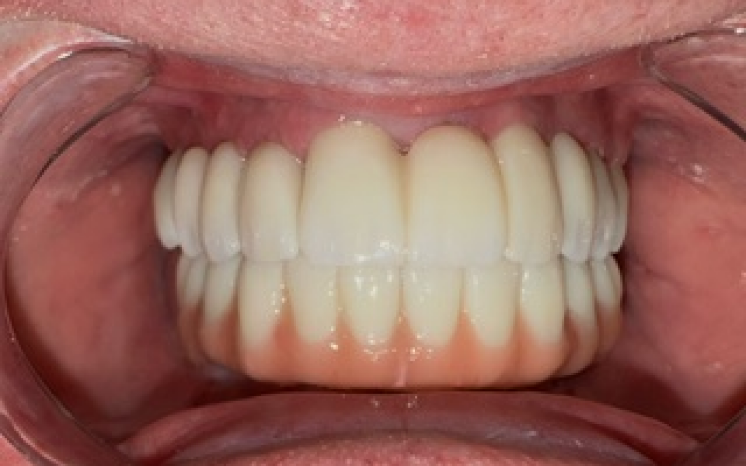 Implants - Drake Dental Lab