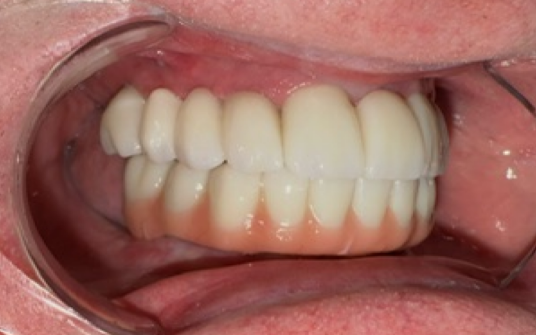Implants - Drake Dental Lab