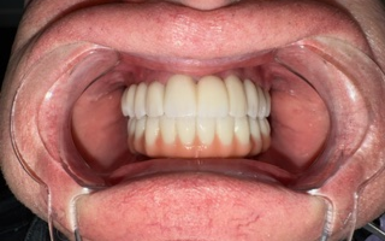 Implants - Drake Dental Lab