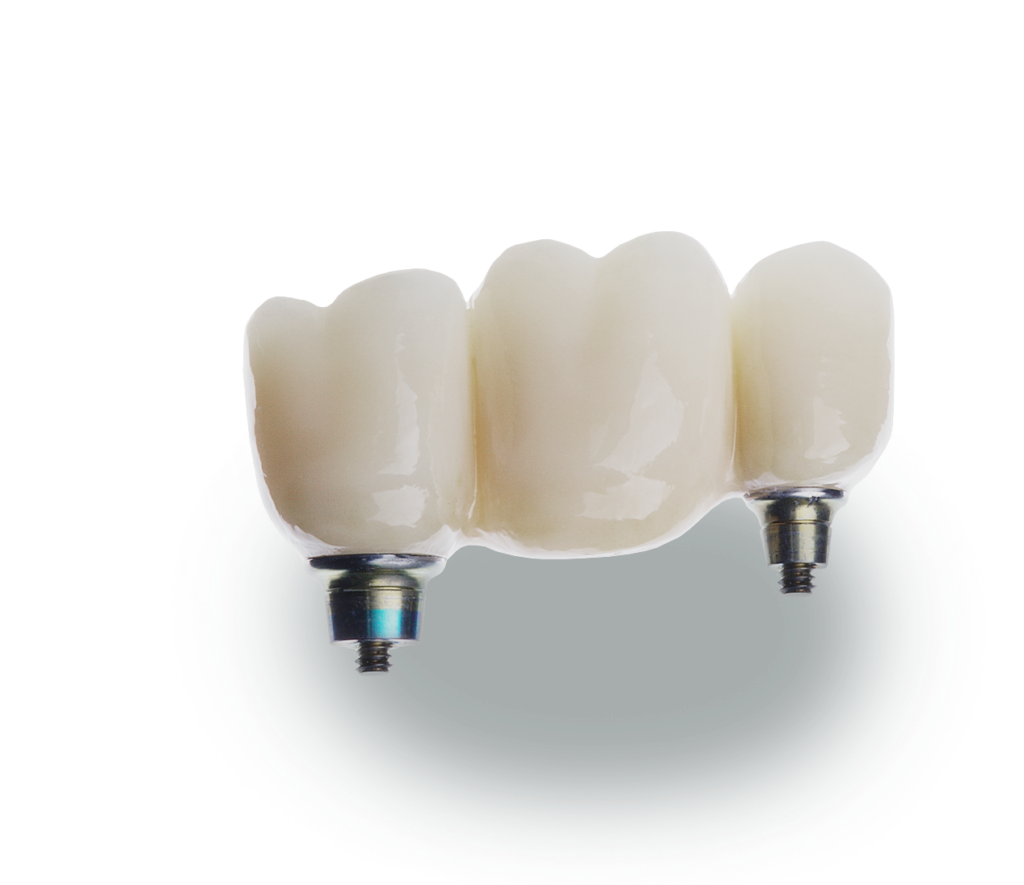 Implants - Drake Dental Lab